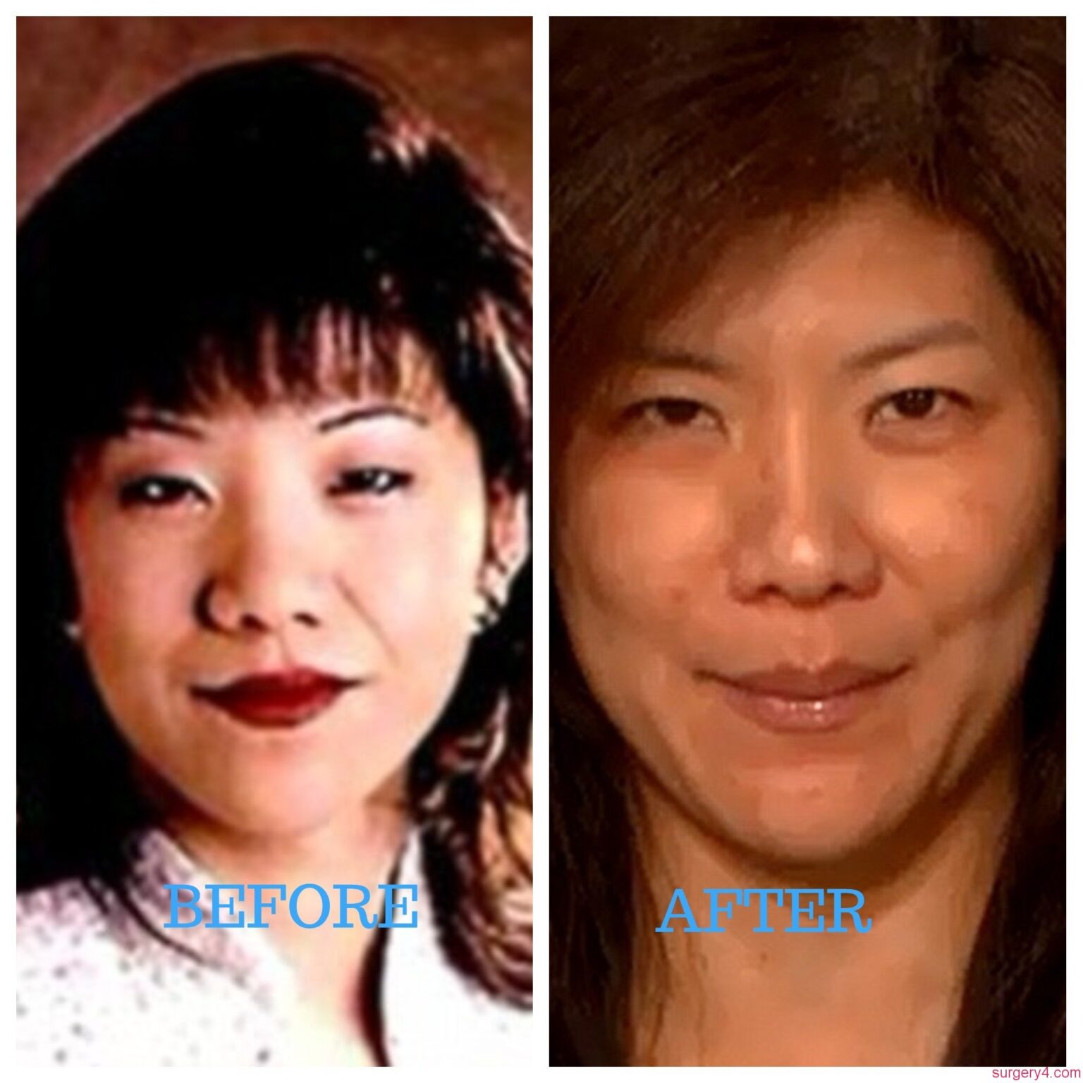 Martha Stewart Plastic Surgery
