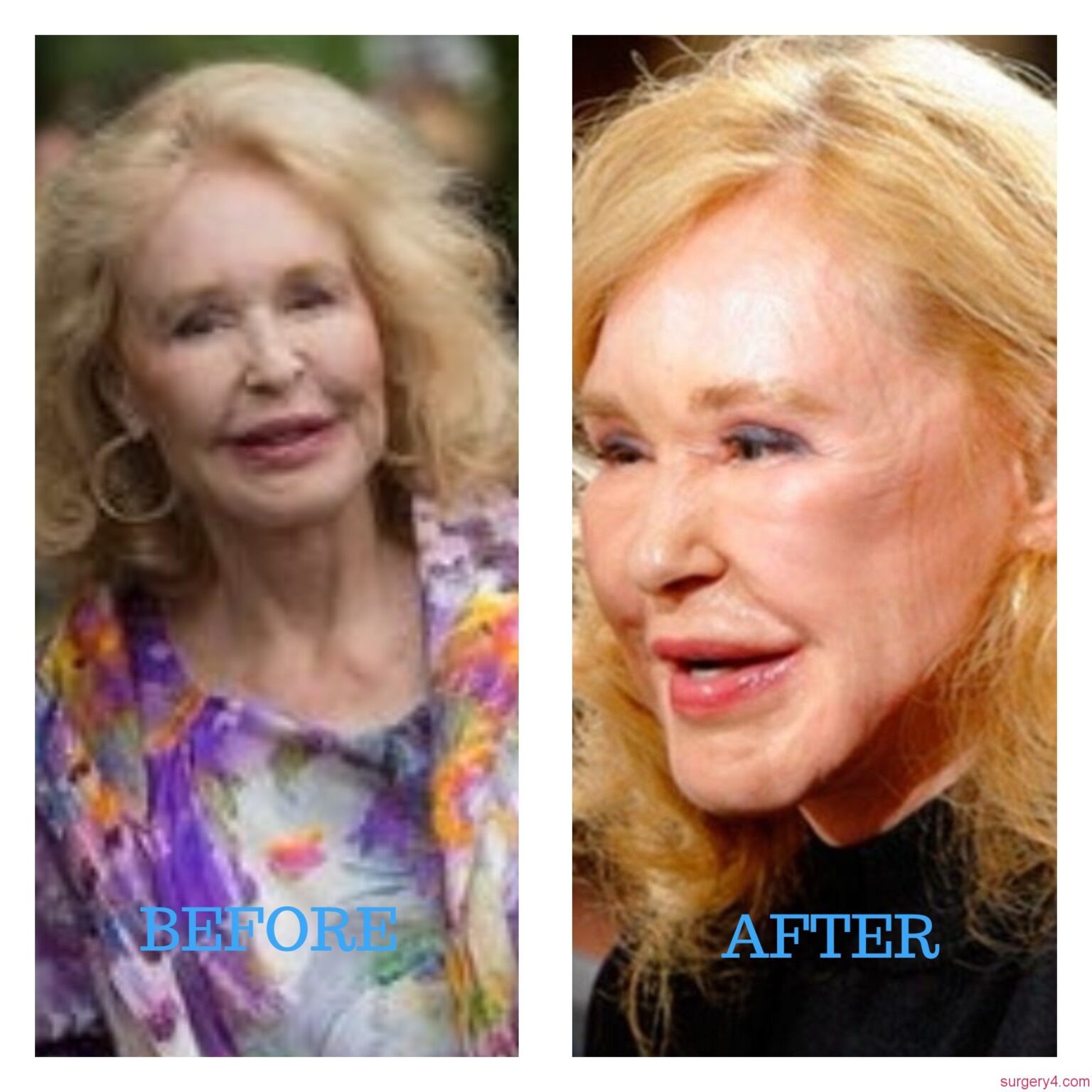Joan Kennedy Plastic Surgery Photos [Before & After] - Surgery4