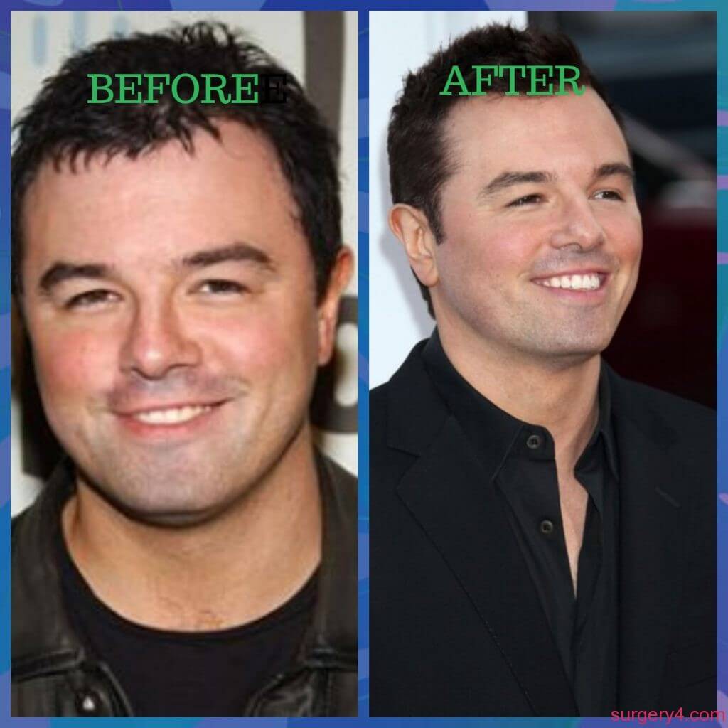 Seth Macfarlane Plastic Surgery Photos [Before & After] - Surgery4