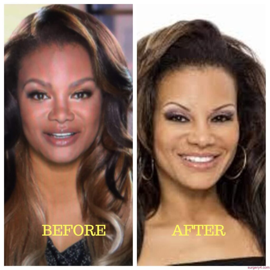 Traci Melchor Plastic Surgery Photos [Before & After] - Surgery4