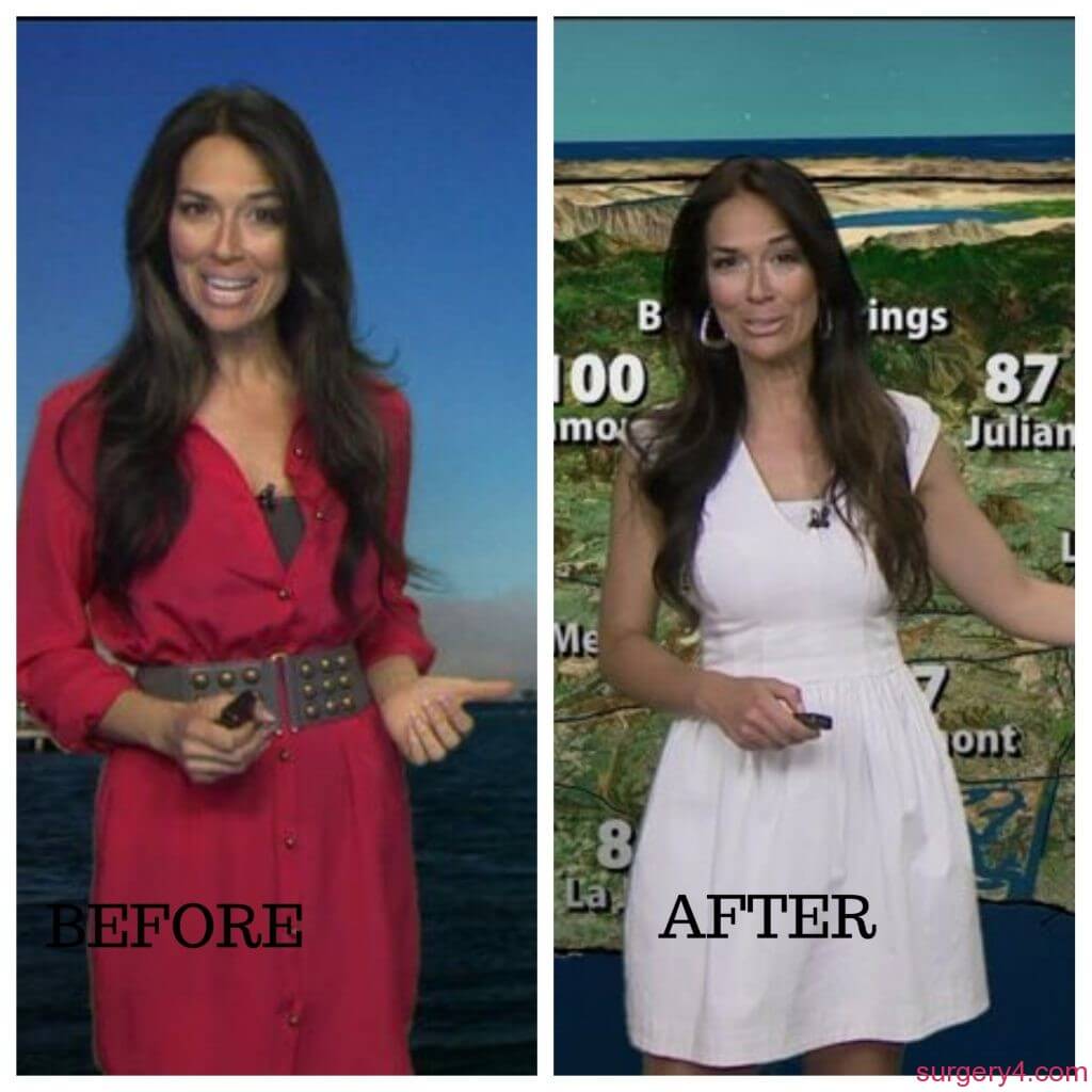 Aloha Taylor Breast Implants Photos [Before & After] - Surgery4