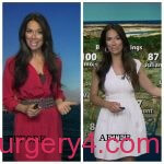 Aloha Taylor Breast Implants Photos [Before & After] - Surgery4