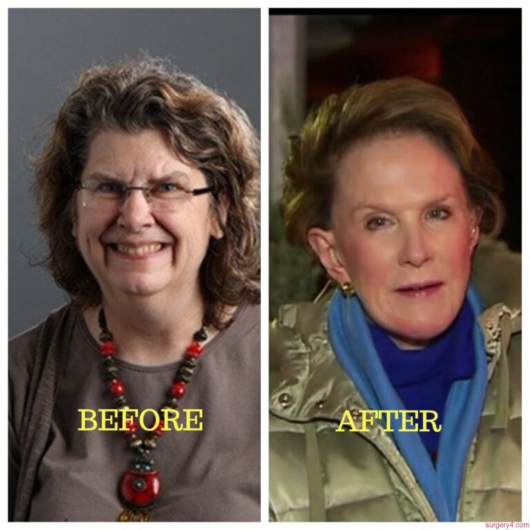Margaret Warner Plastic Surgery Photos [Before & After] - Surgery4